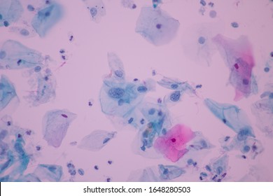 View Microscopic Abnormal Human Cervix Cellssquamous Stock Photo ...