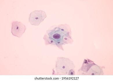 390 Abnormal cervical cells Images, Stock Photos & Vectors | Shutterstock