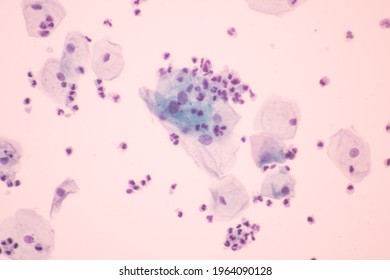 View Microscopic Abnormal Human Cervix Cellssquamous Stock Photo ...