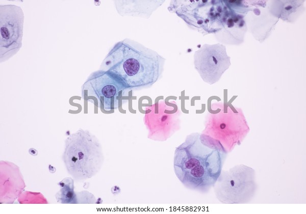 View Microscopic Abnormal Human Cervix Cellssquamous Stock Photo ...