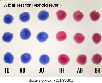 28 Widal test Images, Stock Photos & Vectors | Shutterstock