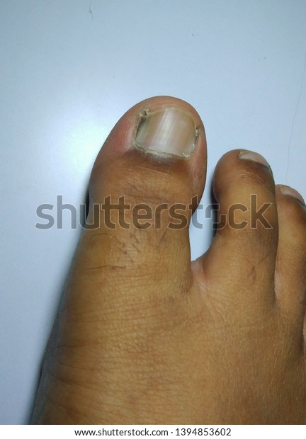 Wierd Human Toe Which Uncleaned Black Stock Photo 1394853602 | Shutterstock