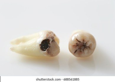 4,047 Decayed Wisdom Tooth Images, Stock Photos & Vectors | Shutterstock