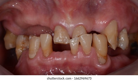 4,272 Worn Teeth Images, Stock Photos & Vectors | Shutterstock