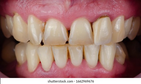 4,272 Worn Teeth Images, Stock Photos & Vectors | Shutterstock