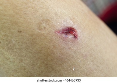 6,275 Bite wound Images, Stock Photos & Vectors | Shutterstock