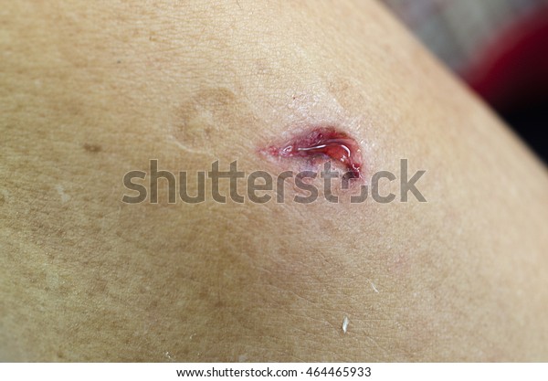 Wound Bite Stock Photo (Edit Now) 464465933