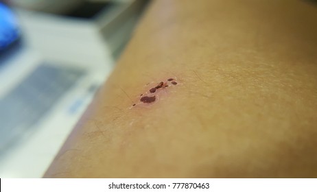 116 Form Scab Images, Stock Photos & Vectors | Shutterstock