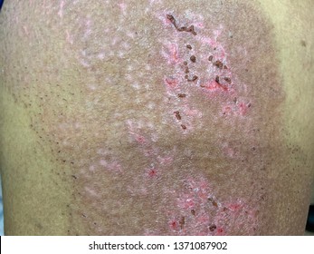 Wound Forms Scabs Stock Photo 1371087902 | Shutterstock