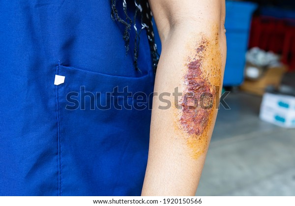 Wound Forms Scabs Stock Photo 1920150566 | Shutterstock