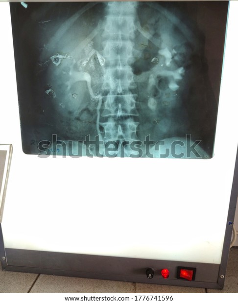 X Ray Coronal Section Human Abdominal Stock Photo 1776741596 | Shutterstock