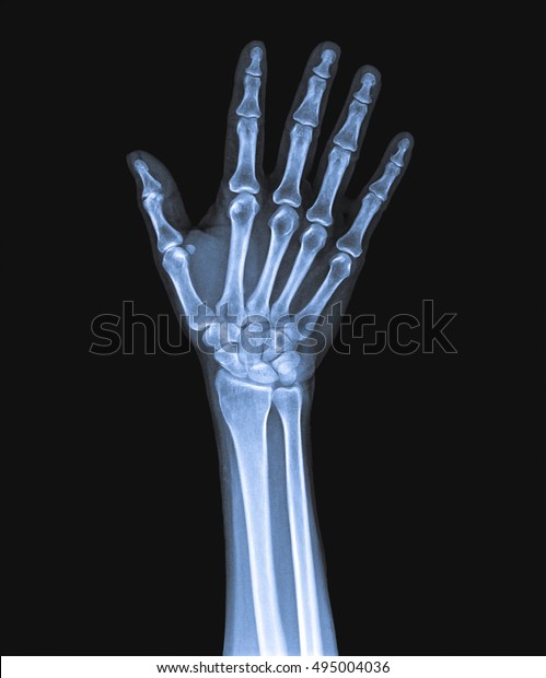 mano de rayos X
