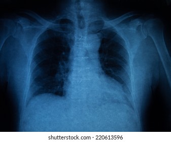 Normal Film Chest Xray Akimbo Position Foto de stock 758292661 ...