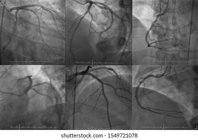 Coronary Angiography Left Right Coronary Angiography Stock Photo ...