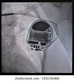 Proximity Telemetry Wand Used Interrogate Pacemaker Stock Photo (Edit ...