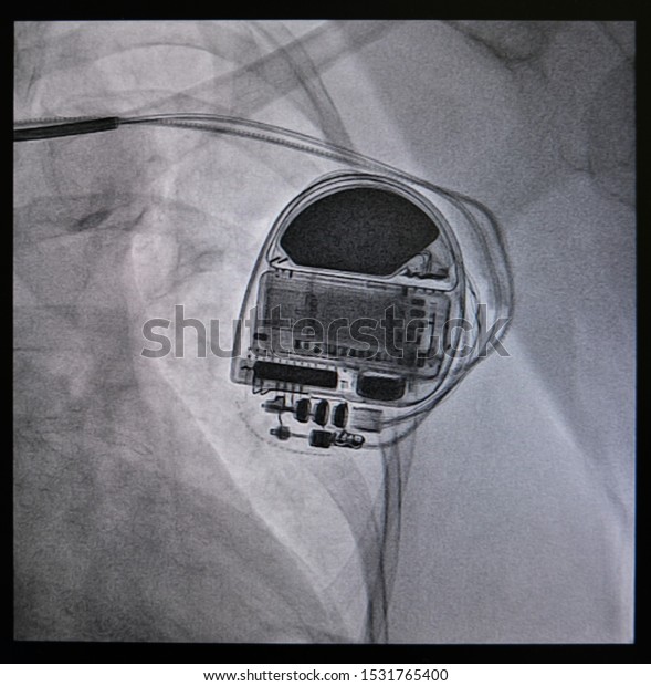 X Ray Image Permanent Pacemaker Implantation Stock Photo 1531765400 ...