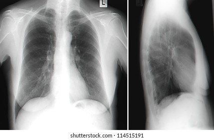 Chest Xray Legionella Pneumonia Extensive Interstitial Foto stock ...