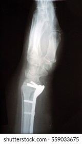 Cervical Spine Xray Showing Spondylosis Kyphotic Stock Photo (Edit Now ...