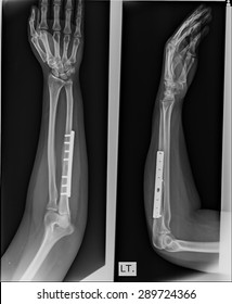 Xray Left Forearm Ap Lat Fracture Stock Photo 1451943380 | Shutterstock