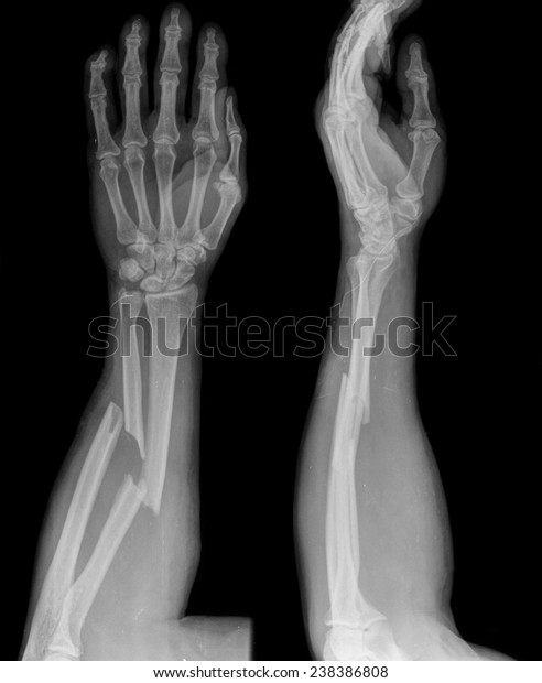 Xray Broken Arm Stock Photo (Edit Now) 238386808