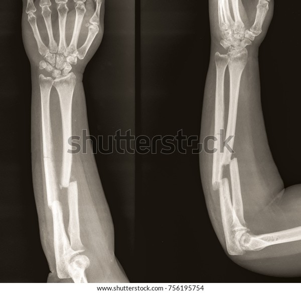 Xray Broken Bone