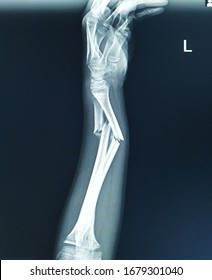 Xray Forearm Lateral View Finding Fracture Stock Photo 1679301040 ...