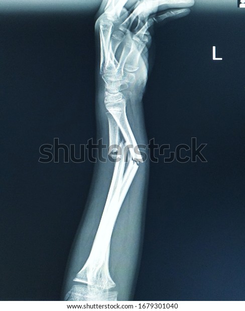 x-ray Forarm 측면 뷰 탐색 왼쪽 스톡 사진 1679301040 | Shutterstock