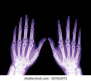 Xray Hands Front View Normal Human Stock Photo 247652971 | Shutterstock