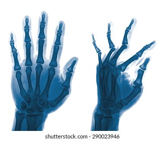 Xray Hands Front View Normal Human Stock Photo 290023946 | Shutterstock