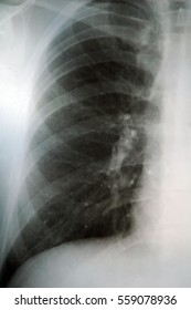 Pneumoperitoneum Lld Abdominal Xray On Lateral Stock Photo (Edit Now ...