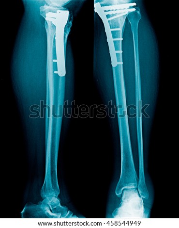 Xray Image Bone Fracture Tibia Open Stock Photo (Edit Now) 458544949 ...