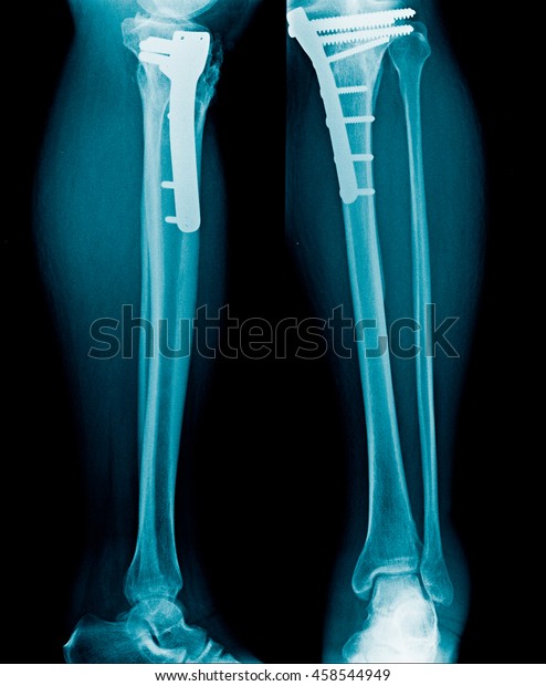 Xray Image Bone Fracture Tibia Open Stock Photo (Edit Now) 458544949