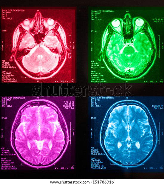 Xray Image Brain Computed Tomography Stock Photo 151786916 | Shutterstock