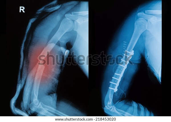 Xray Image Broken Arm Bone Show Stock Photo (Edit Now) 218453020