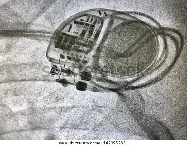 Xray Image During Permanent Pacemaker Implantation Stock Photo (Edit ...