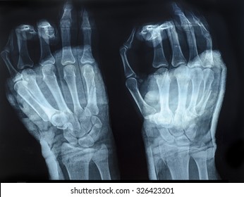 Film Xray Foot Apoblique View Show ภาพสต็อก 583947124 | Shutterstock
