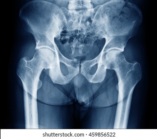 Xray Image Normal Hips Joint Pelvis Foto Stok 459856522 | Shutterstock