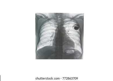 89 Permanent Pacemaker Images, Stock Photos & Vectors | Shutterstock