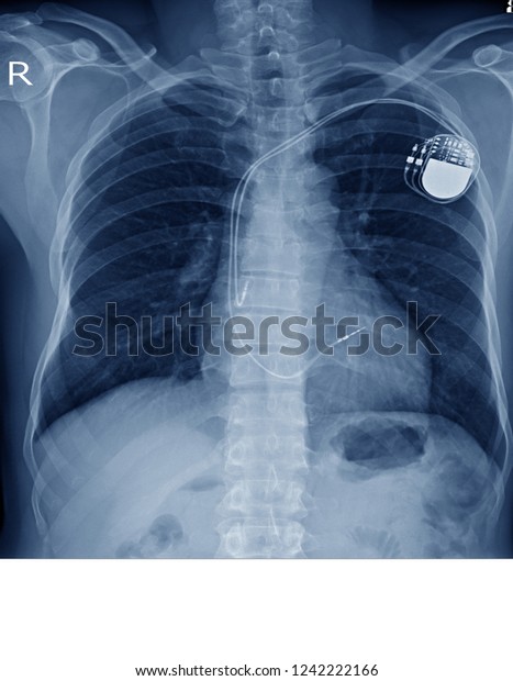 x-ray image of permanent pacemaker implant in chest body , process in ...