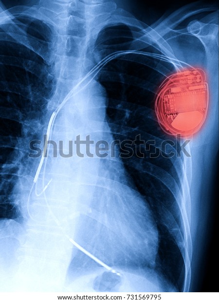 Xray Image Permanent Pacemaker Implant Chest Stock Photo 731569795 ...