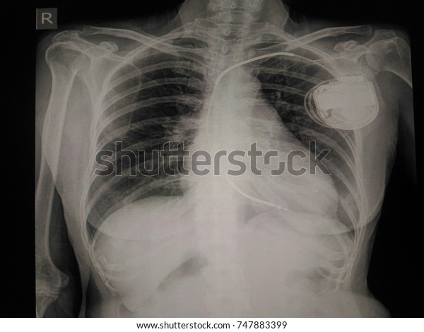 Xray Image Permanent Pacemaker Implant Chest Foto de stock 747883399 ...