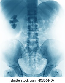 Xray Image Plain Kub Kidney Ureter Stock Photo 408564409 | Shutterstock