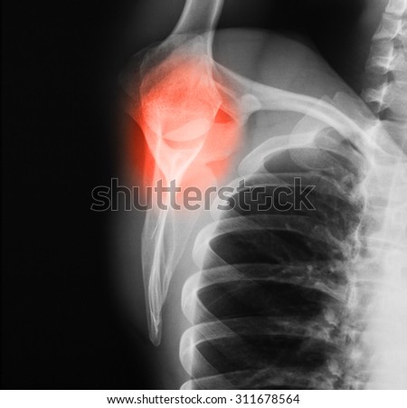 Xray Image Shoulder Transcapular Y View Stock Photo (Edit Now ...