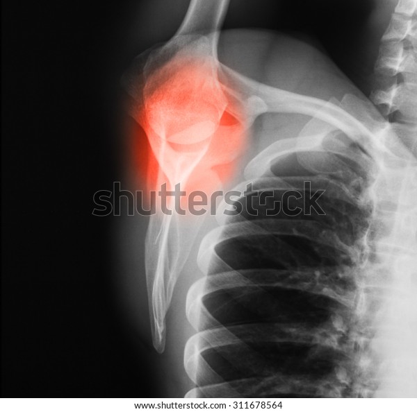 Xray Image Shoulder Transcapular Y View Stock Photo (Edit Now) 311678564