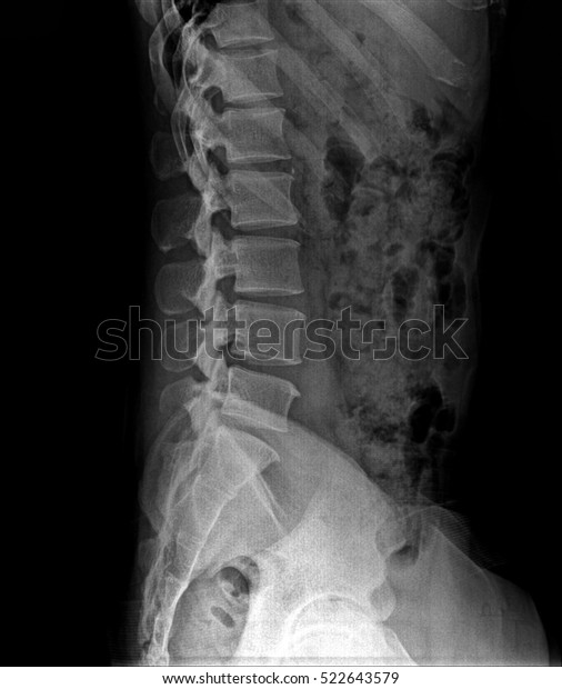 Xray Image Spine Side View Human Stock Photo (Edit Now) 522643579