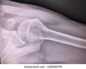 Transaxillary: ภาพ ภาพสต็อกและเวกเตอร์ | Shutterstock