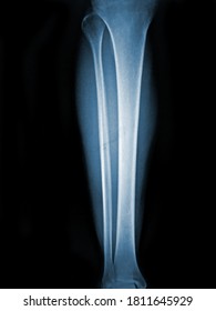 Xray Normal Human Tibia Lateral View Stock Photo 1811645929 | Shutterstock