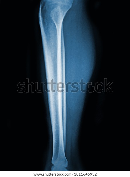 Xray Normal Human Tibia Lateral View Foto Stok 1811645932 | Shutterstock