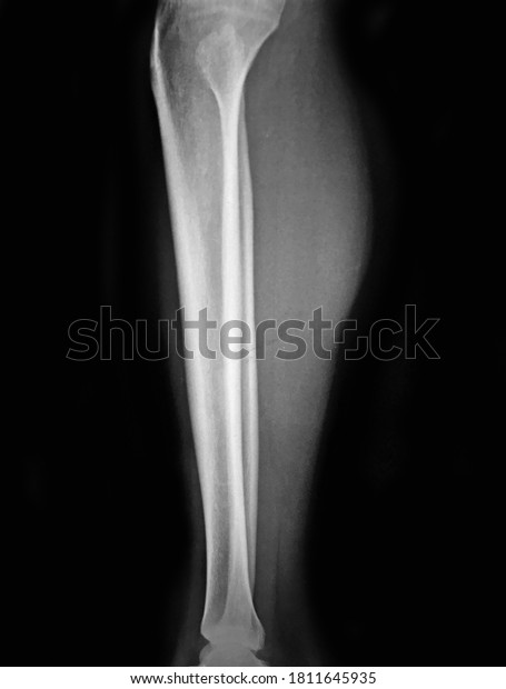 Xray Normal Human Tibia Lateral View ภาพสต็อก 1811645935 | Shutterstock