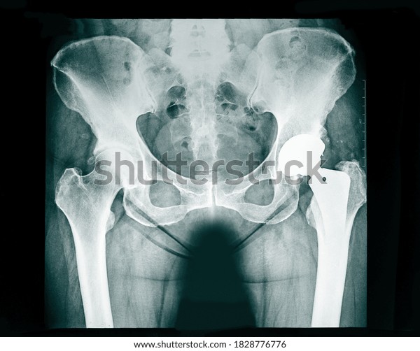 Xray Pelvis Endoprosthesis Socket Hip Joint Stock Photo 1828776776 ...
